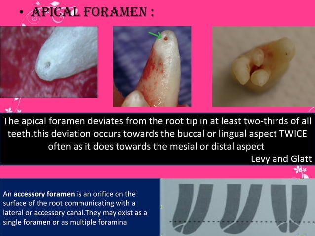 Working length determination | PPT | Dental Health | Diseases and ...