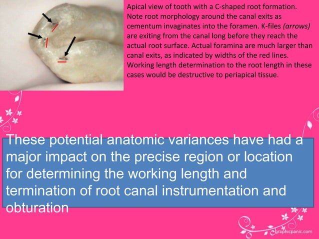 Working length determination | PPT | Dental Health | Diseases and ...
