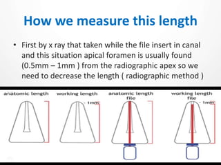 Working length determination apex and the methods | PPTX | Dental Health | Diseases and Conditions