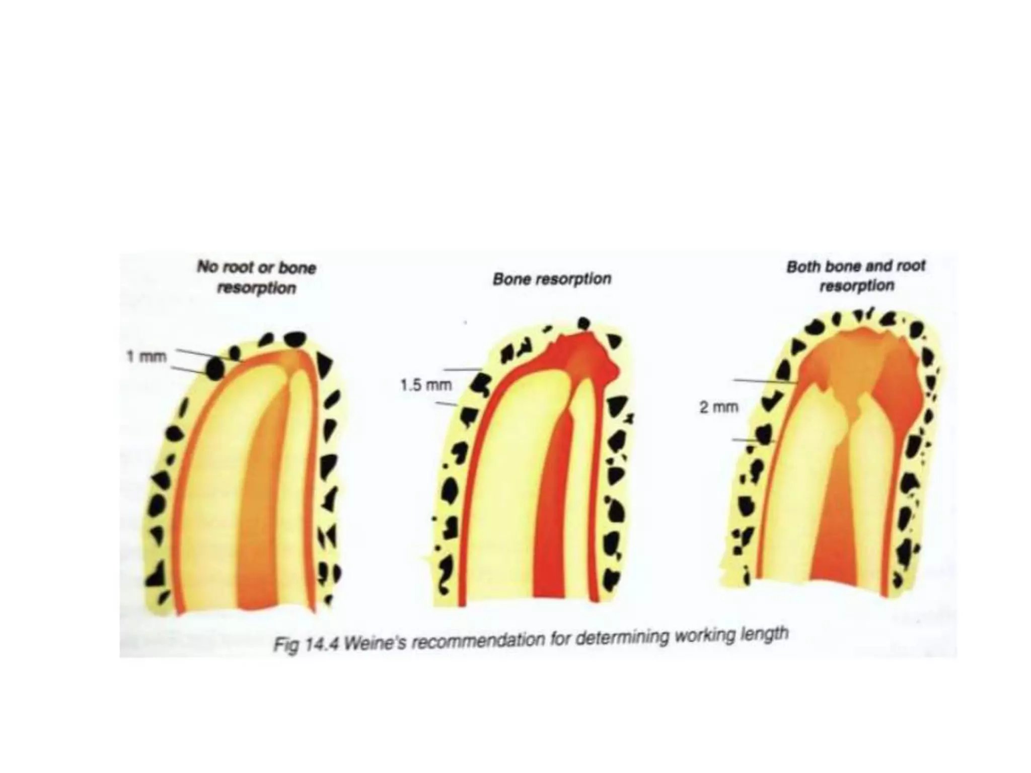 Working length determination | PPT