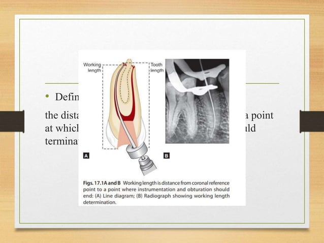 working length determination.pptx | Dental Health | Diseases and Conditions