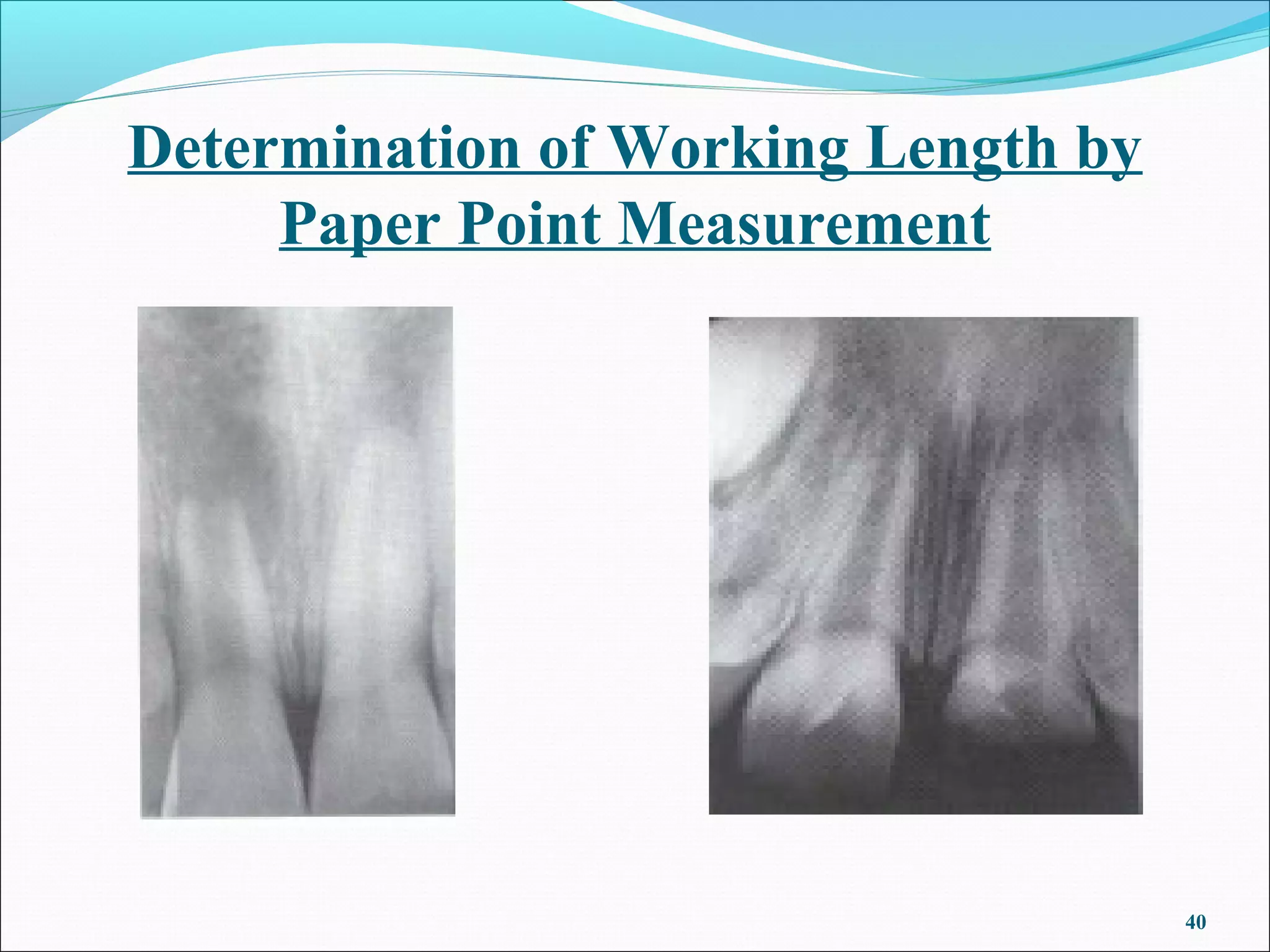 Working Length Determination Ppt