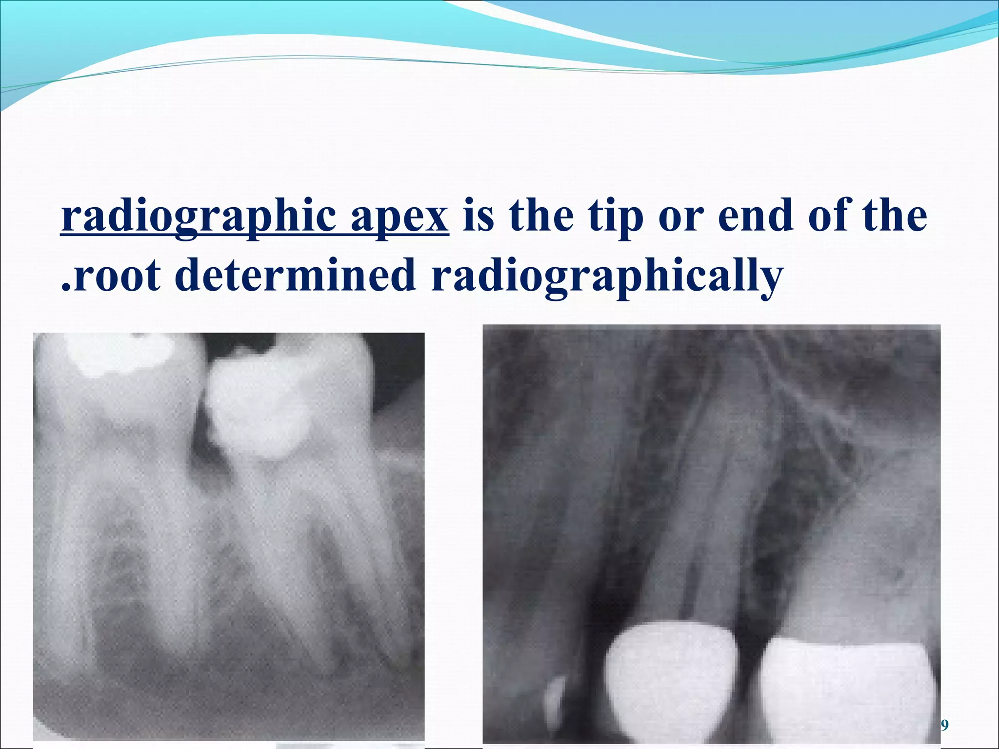 Working length determination | PPT