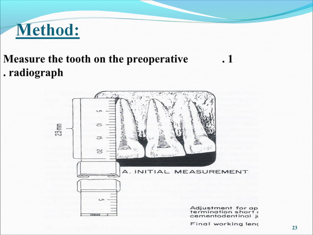 Working length determination | PPT | Dental Health | Diseases and ...