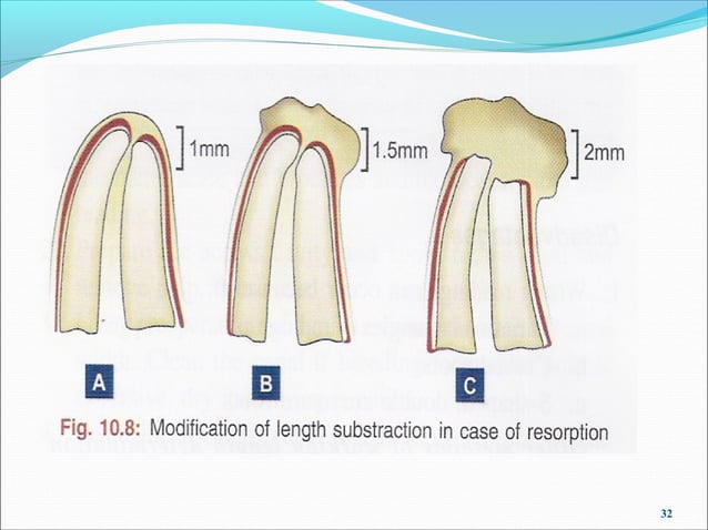 Working length determination | PPT | Dental Health | Diseases and ...