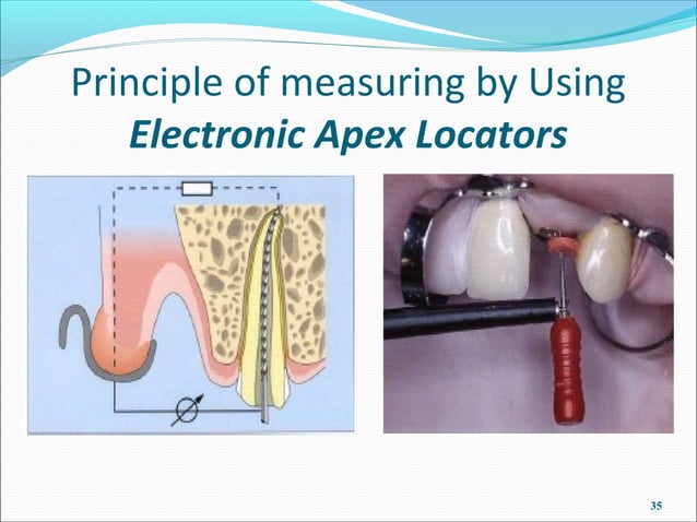 Working length determination | PPT | Dental Health | Diseases and ...