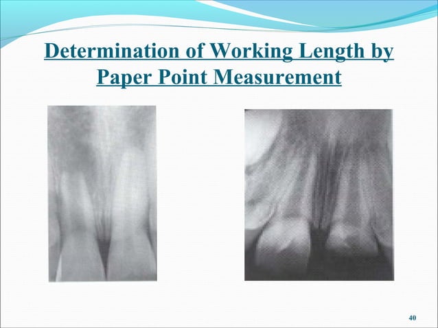 Working length determination | PPT | Dental Health | Diseases and ...