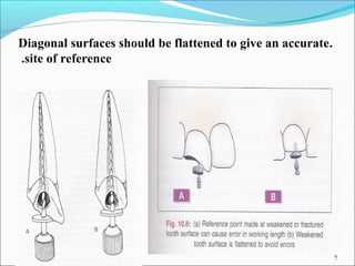 Working length determination | PPT