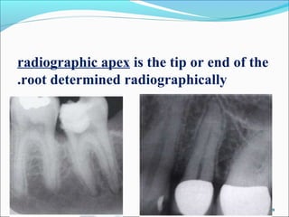 Working length determination | PPT