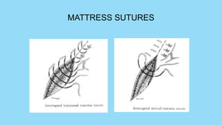 Workshop on Basic Principles of Sutures , Wound.pptx