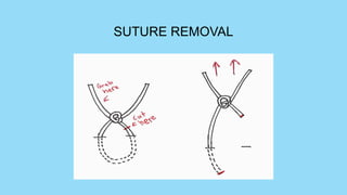 Workshop on Basic Principles of Sutures , Wound.pptx