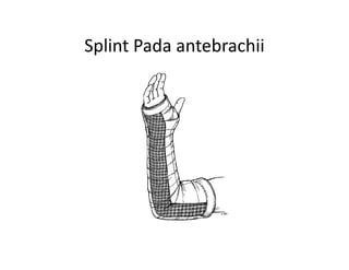 Workshop splinting technique for temporary immobilisation oleh dr Broto ...