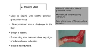 non-healing ulcer work up powerpoint presentation | PPTX