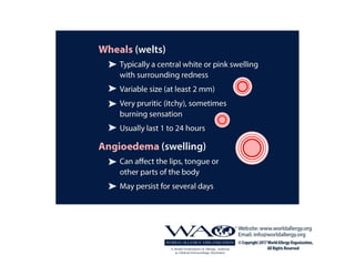 World Allergy Week 2017 slides - Chronic urticaria | PPT