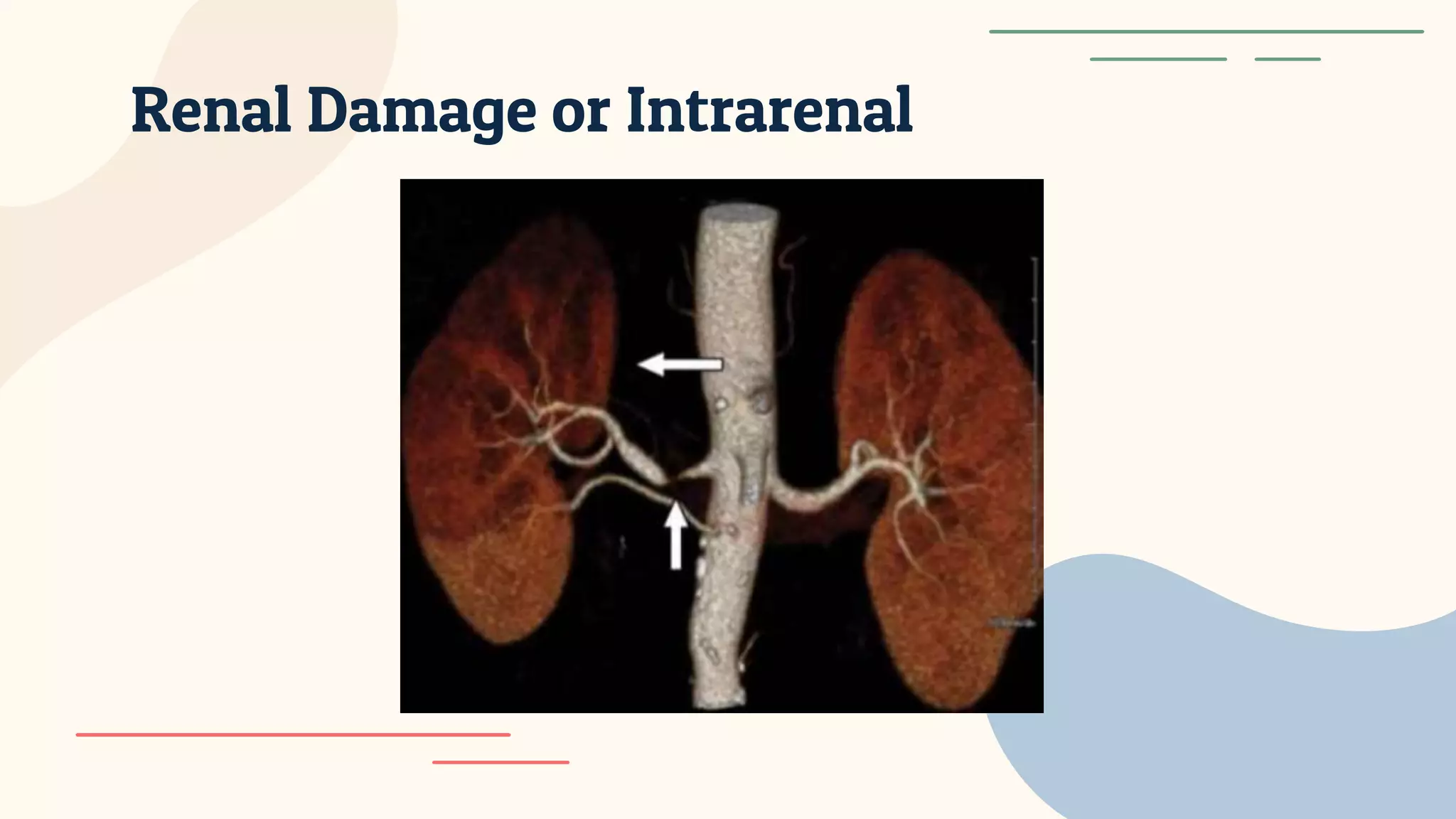 Renal Failure Disease | PPTX