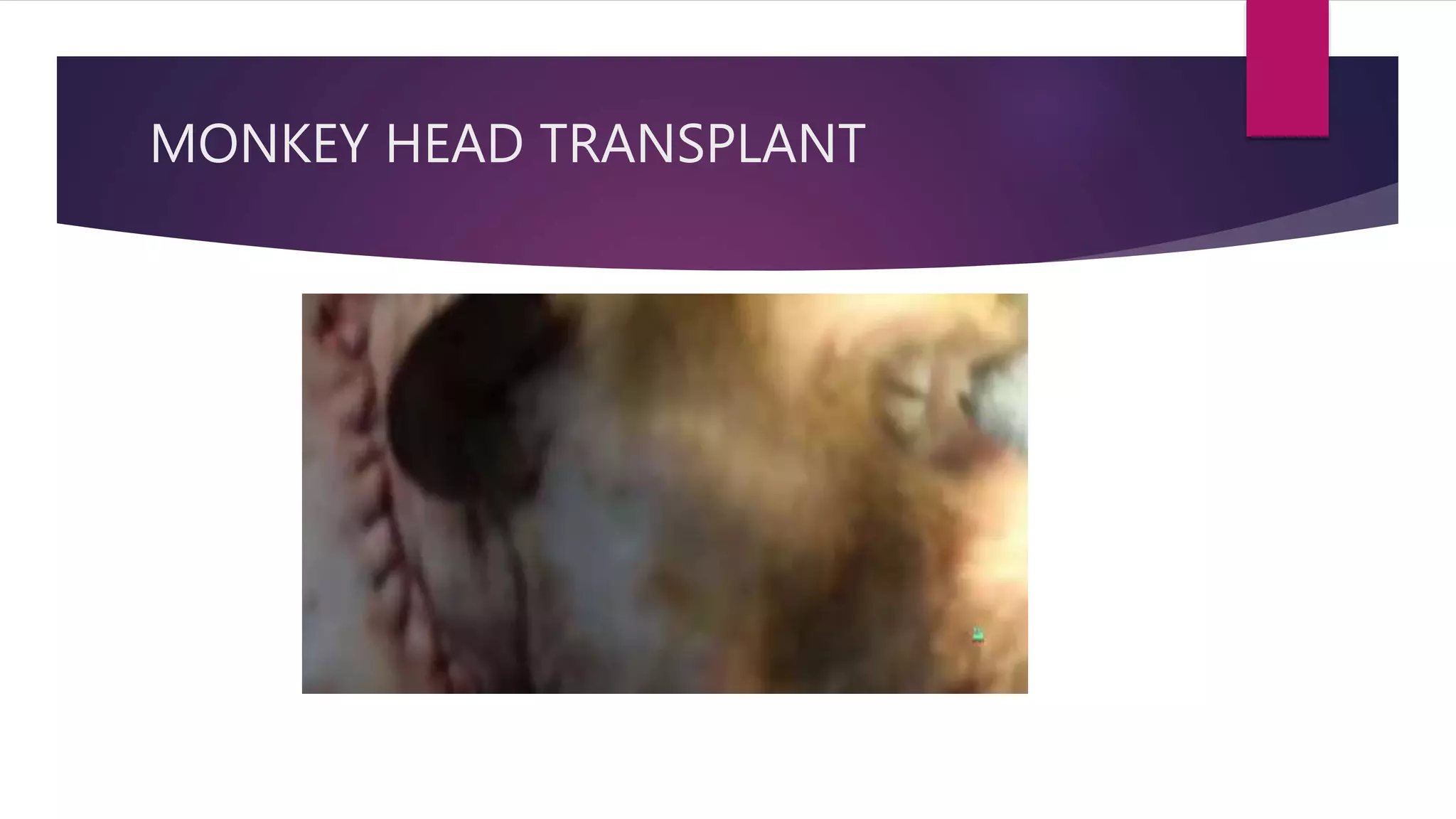 World’s first human head transplantation | PPTX