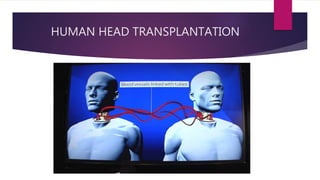 World’s first human head transplantation | PPTX
