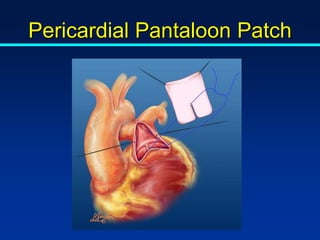 Tetralogy of fallot-Pumlmonary valve preservation | PPT
