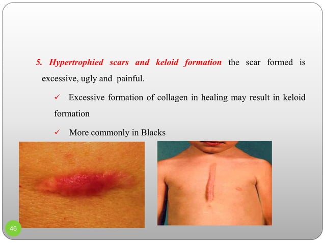Wound | PPT