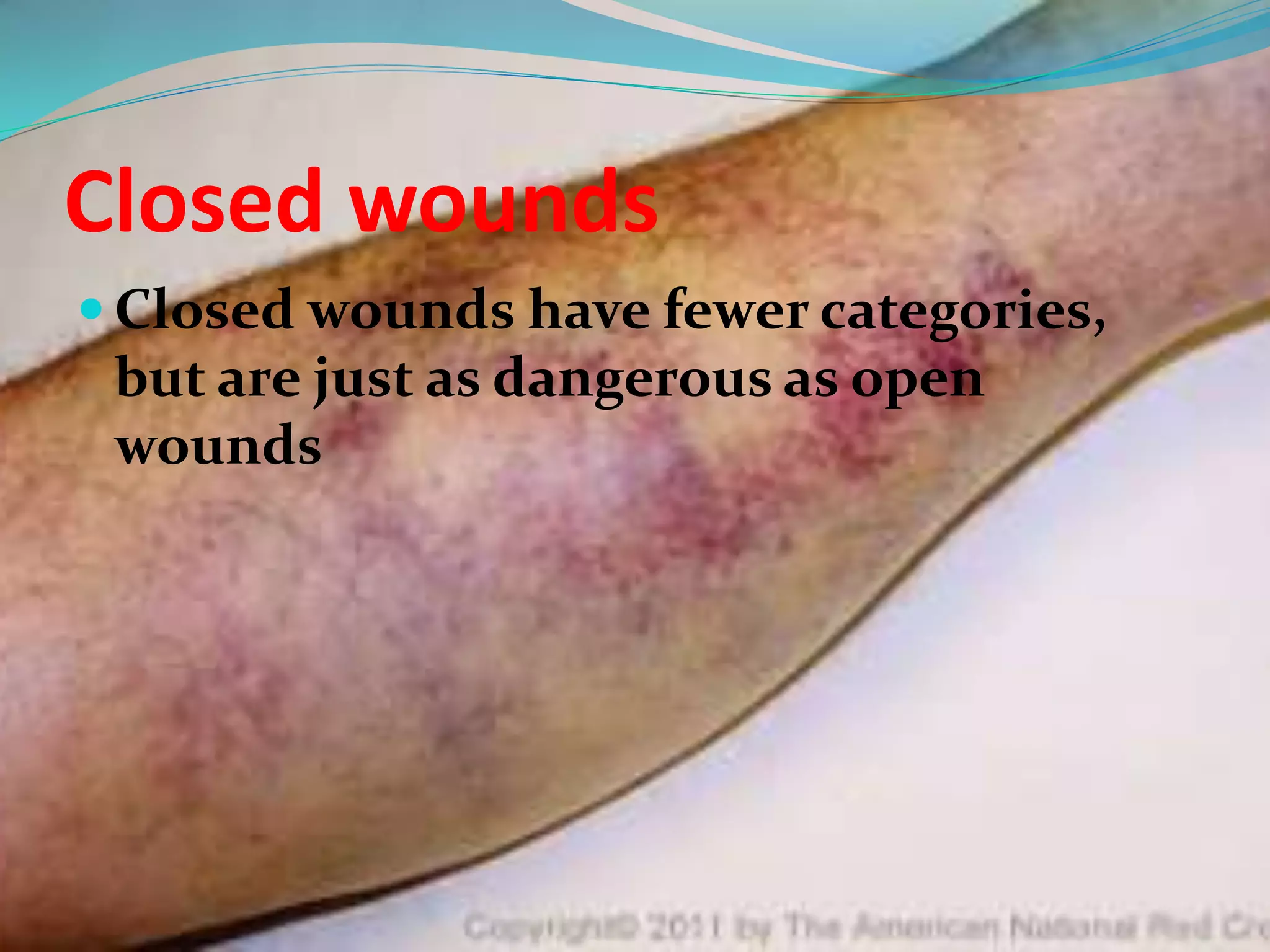 Wound | PPTX
