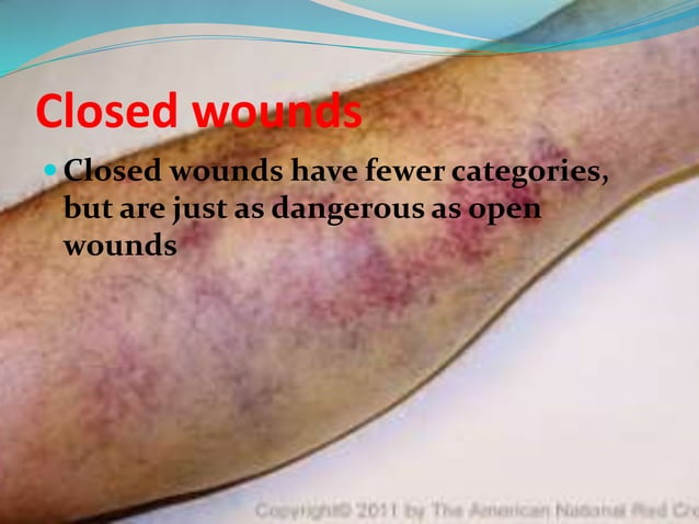 Wound | PPTX | Death, Injury, or Military Conflict | Sensitive Topics