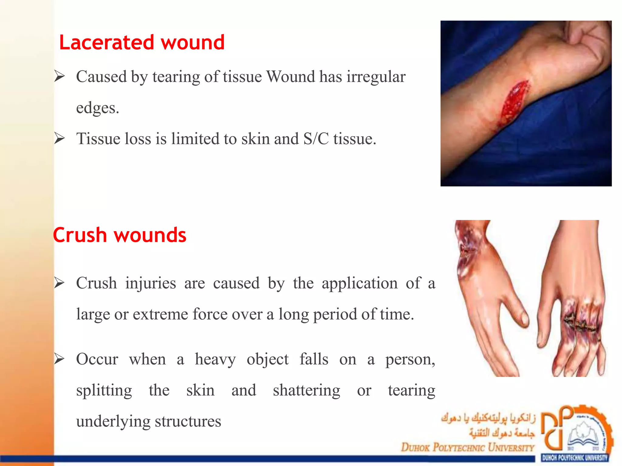 Wound.ppt