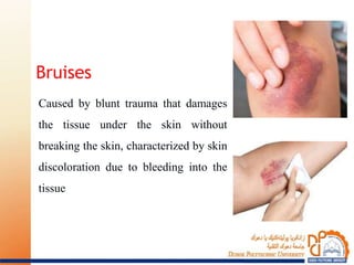 Wound.ppt