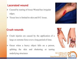 Wound.ppt