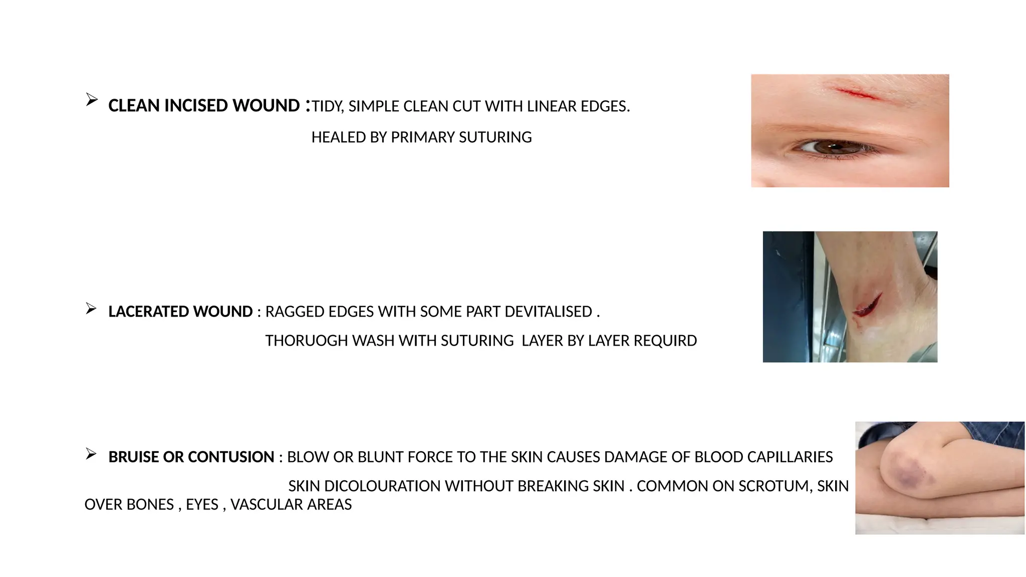 Wound Healing According to Modern and Ayurveda | PPTX