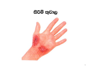 Types of Wounds and First Aid. find you | PDF