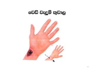 Types of Wounds and First Aid. find you | PDF