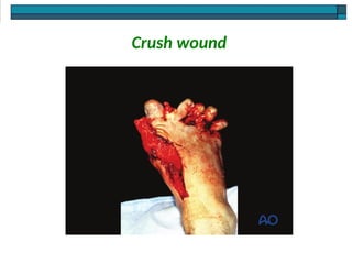 Wound , Wound healing , Factors affecting wound healing | PPTX