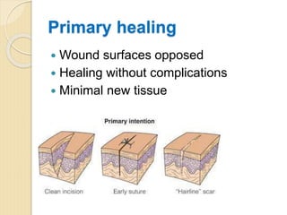 Wound healing | PPT