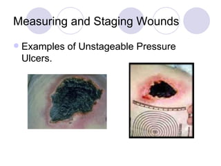 Wound Measuring And Staging Inservice | PPT