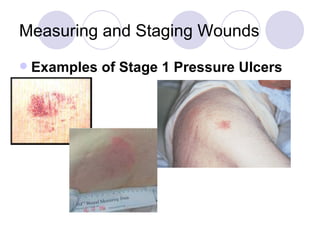 Wound Measuring And Staging Inservice | PPT
