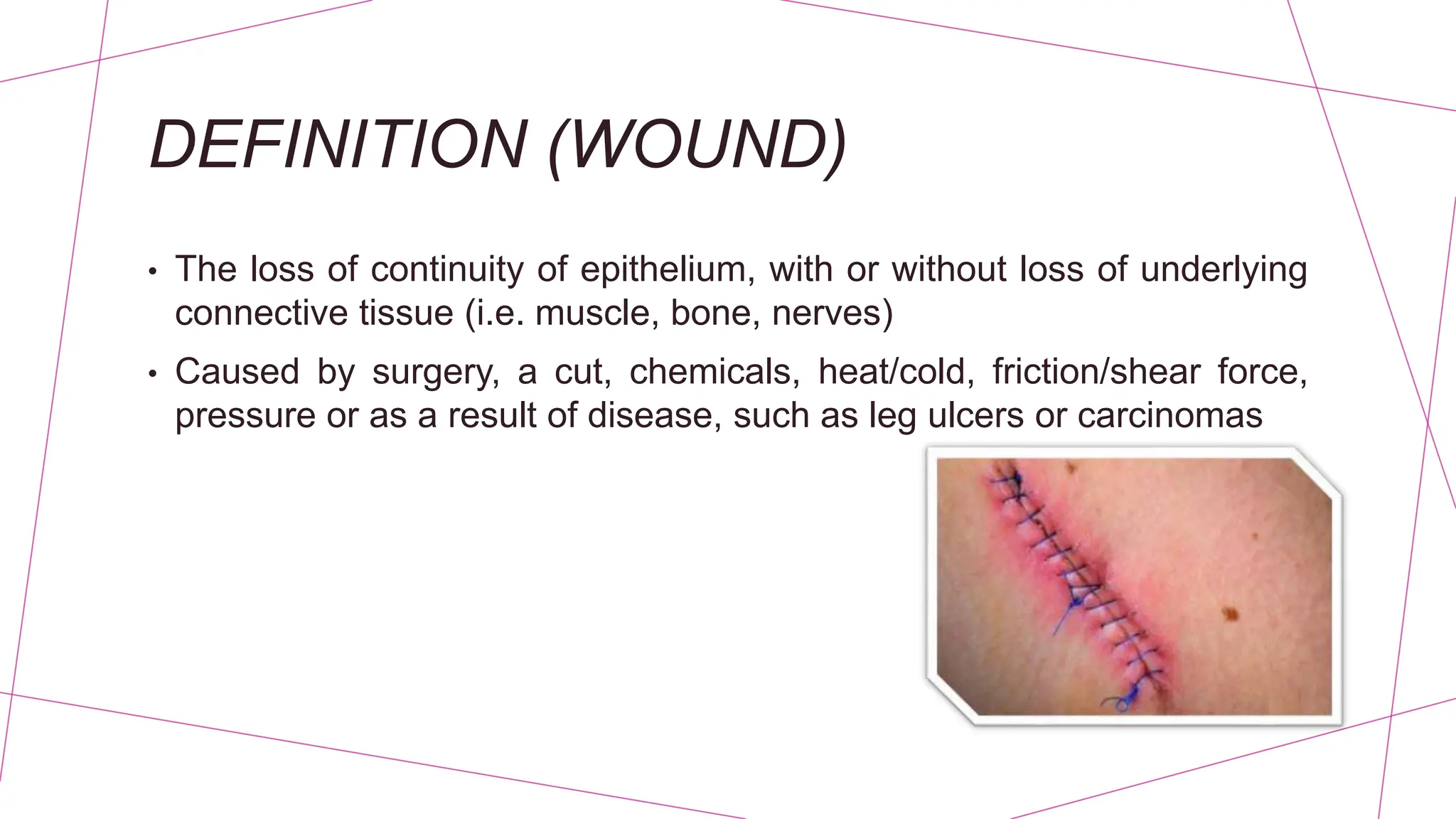 Stages of Wound and Bone Healing (Ortho) | PPTX