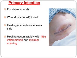 wound and types wound healing and dressing.pptx