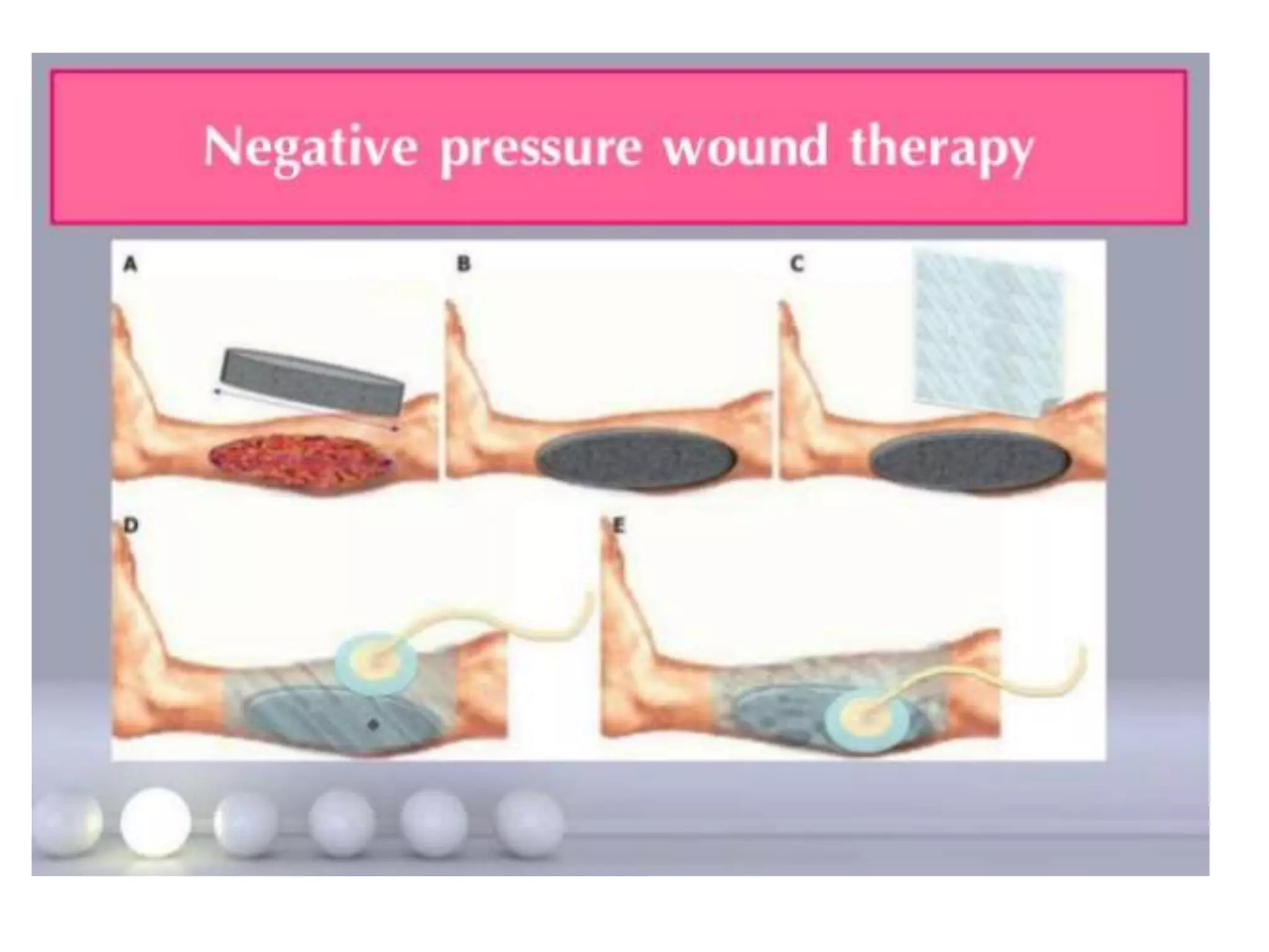 Wound assessment and modern dressing | PPTX