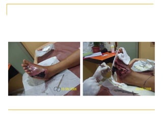 Wound bed preparation | PPT