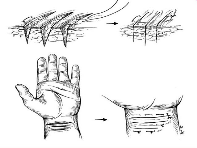 How To Care for Traumatic Wounds