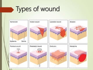Types Of Wound Dressings