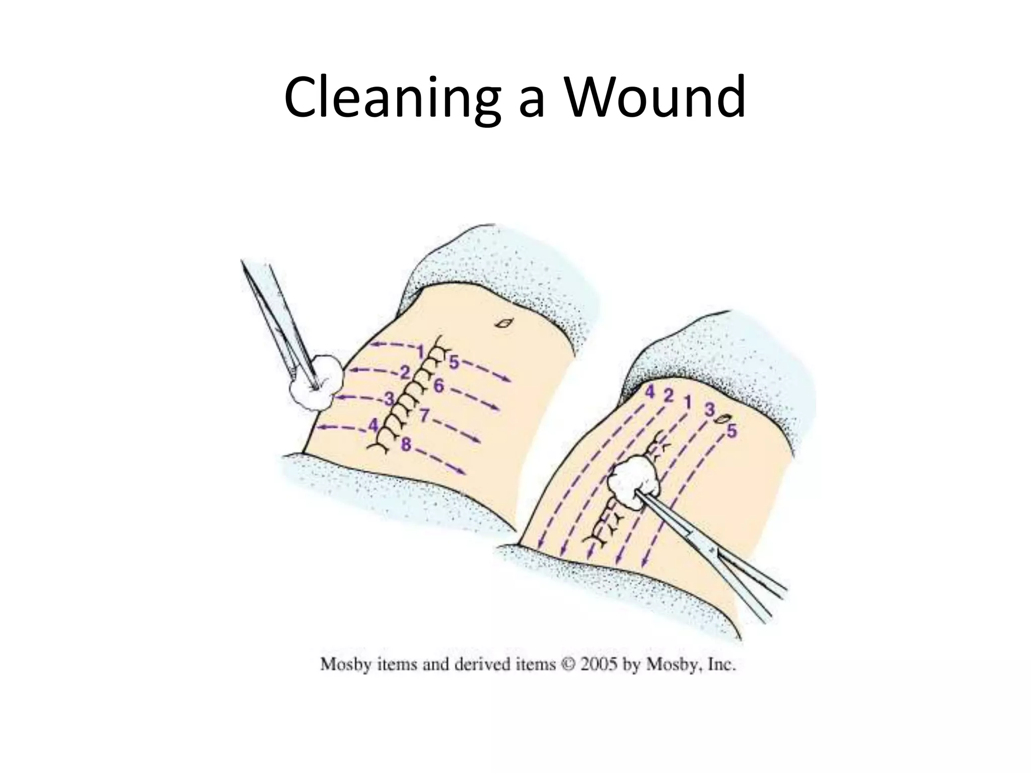Wound care | PPTX
