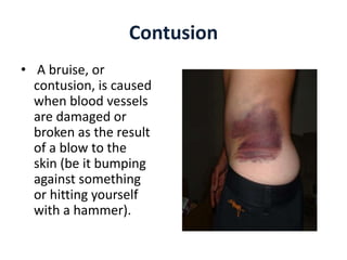Wound care and treatment for nursing | PPTX