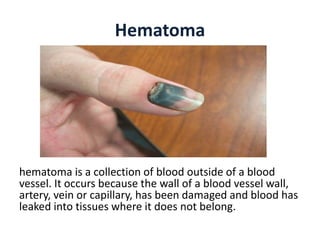 Wound care and treatment for nursing | PPTX