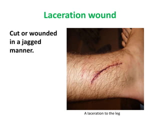 Wound care and treatment for nursing | PPTX