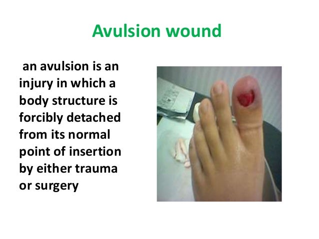 Skin Avulsion Treatment