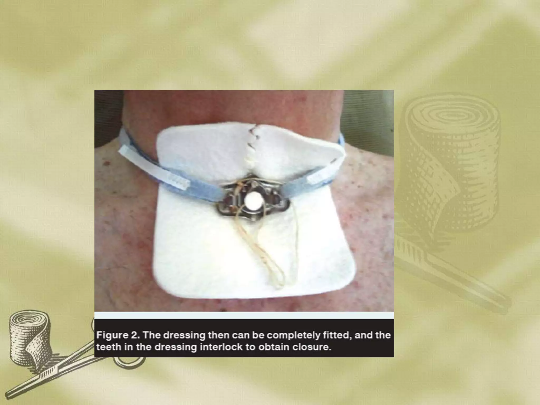 Wound care dressing and products | PPTX