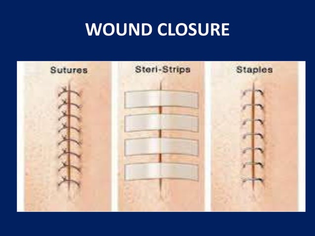 Wound care essentials | PPTX