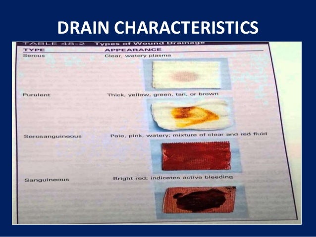 Serosanguineous Fluid