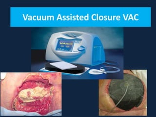 wound dressing for chronic wound | PPTX
